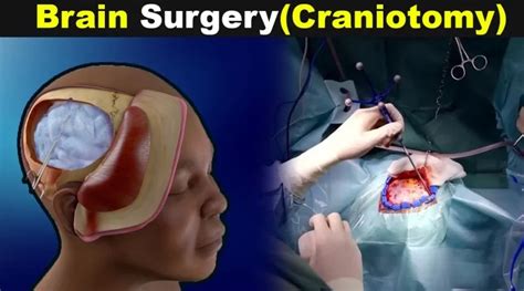 Craniotomy Side Effects Archives Samarpan Physiotherapy Clinic Ahmedabad