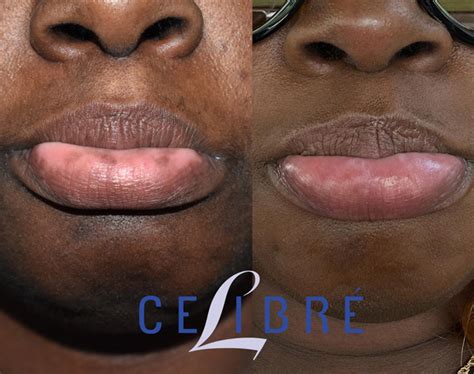Brown Spots On Lips Treatments Results In 4 7 Days