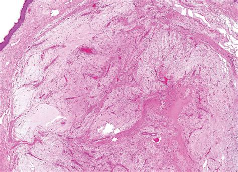 Myxoid Cutaneous Tumors A Review Zou 2016 Journal Of Cutaneous Pathology Wiley Online
