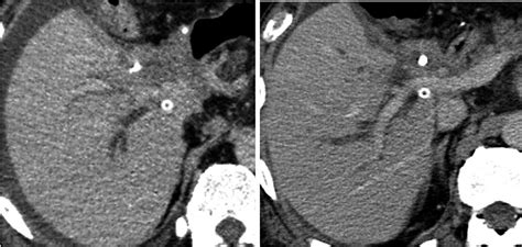 Novel Approach To Complete Anastomotic Obstruction After