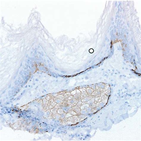 Pdf Cutaneous Dermoid Cyst Cytokeratin And Filaggrin Expression