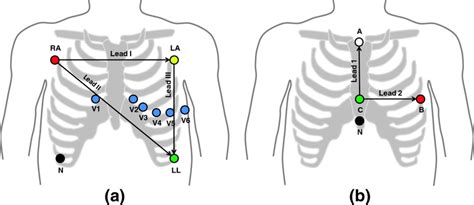 12 Lead Ecg Electrode Placement