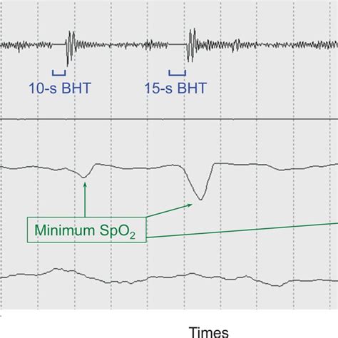 Representative Polygraph Traces Of Air Flow Spo2 And Pulse Rate