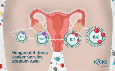 Mengenal 4 Jenis Kanker Serviks Stadium Awal