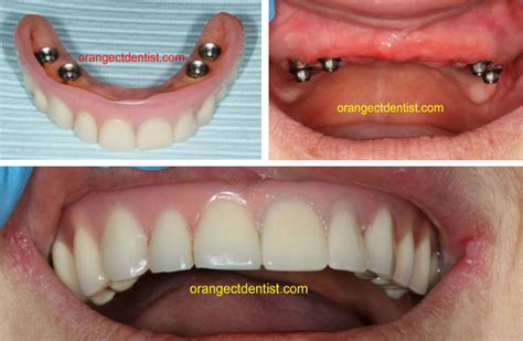 Complete Denture With Implants At Greg Howell Blog
