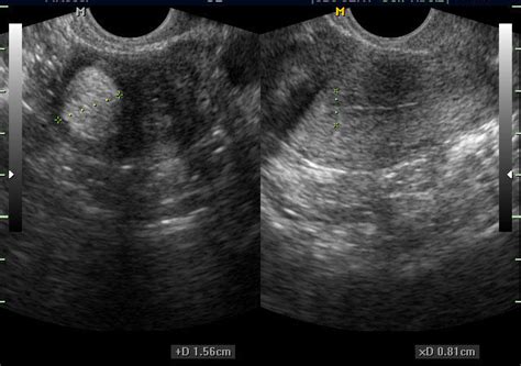 Drfiroozeh Ahmadi On Linkedin Echogenic Fibroid “lipofibroma” In