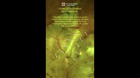 Staphyloma Optic