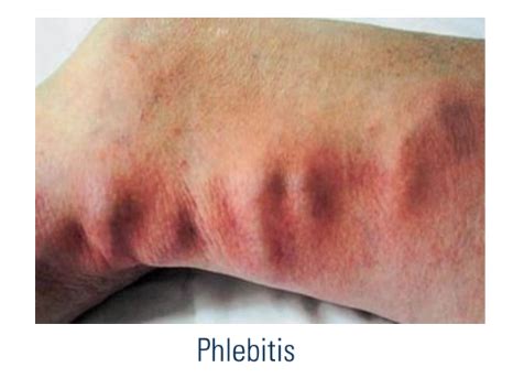 Phlebitis The Vascular Care Group