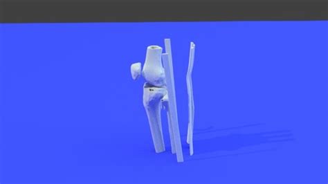 Tib Fib Trial Stl File Processed Democratiz3d® Processing