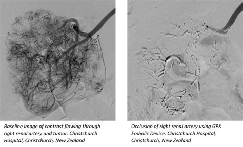 Multi Center Liquid Embolic Study Concludes