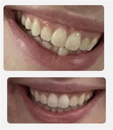 Before And After Relatively Small Adjustment… Over The Moon R Invisalign