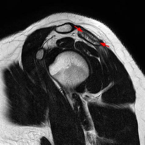 Acromial Stress Fractures After Shoulder Decompression Surgery Radsource
