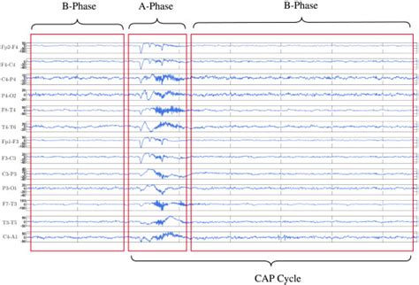 Automated Phase Classification In Cyclic Alternating Patterns In Sleep
