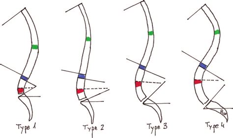 Roussouly Sagittal Shape Classification In Four Types Lumbar Apex In