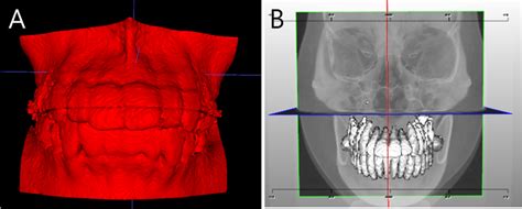 Segmentation Of The Maxilla Mandible And Teeth From Cbct A