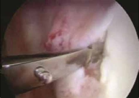 Detachment Of The Labrum Download Scientific Diagram