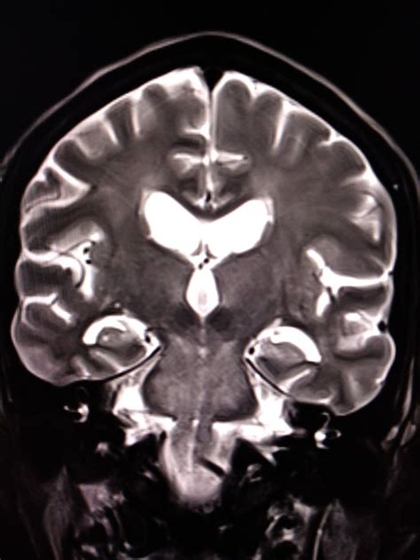 Osmotic Demyelination Syndrome Radiology Imaging Neurology Radiology