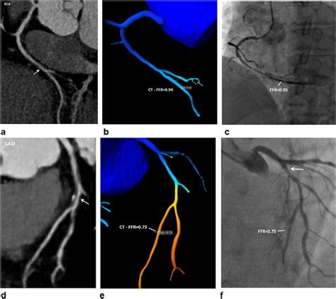 Ct Ffr In Detecting Lesion Specific Ischemia Ac A 64 Year Old Male Download Scientific