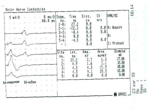 Trace Of H Reflex Recording The Maximum M Response Amplitude And The Download Scientific