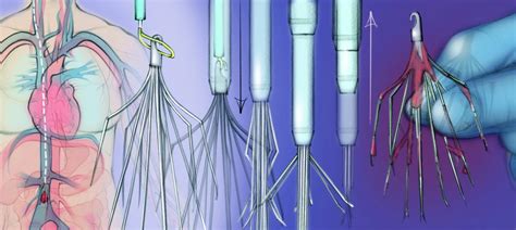 Ivc Filter Removal — The Interventional Initiative