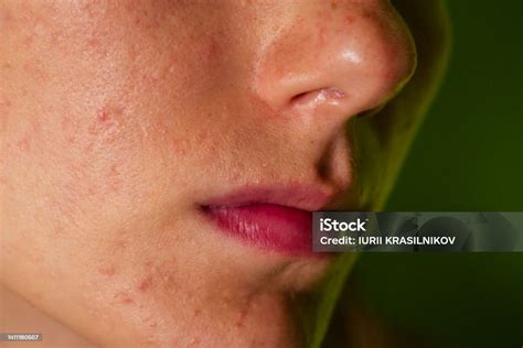 여드름 후 흉터와 붉은 색 여드름은 젊은 여자의 얼굴에 피부 문제 및 고조파 실패의 개념 사람 얼굴에 대한 스톡 사진 및 기타