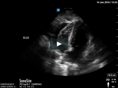 Cardiac Video 9 Subxiphoid View Of Pericardial Effusion With Cardiac