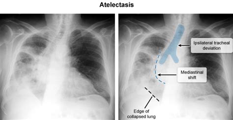 Tracheal Deviation Tension Pneumothorax Pneumothorax Practice