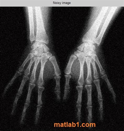 Noise Filtration Technique For Medical Imaging Matlab One