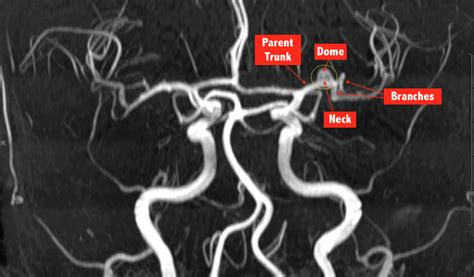 6 Mri A Cow Left Mca Aneurysm Cns Neurosurgery