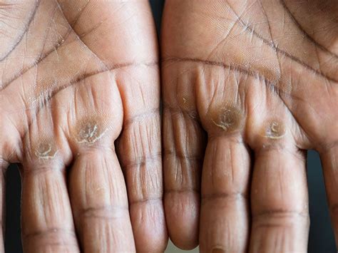 How To Get Rid Of Calluses On Your Hands Buildingrelationship21