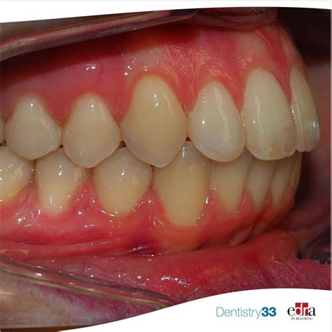 Effects Of Distalization Directions Methods On Maxillary Total
