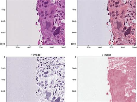 Multimodal Artificial Intelligence Based Pathogenomics Improves