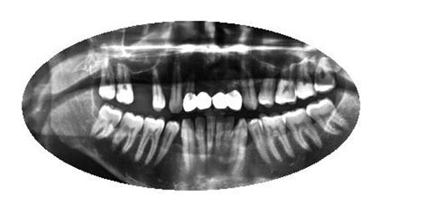 Dental Cavity Object Detection Model By Bhoomikashetty
