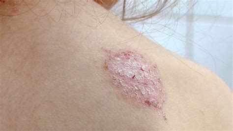 Ringworm Vs Eczema Symptoms Causes Treatments