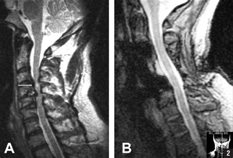 Cervical Mri Of A 52 Year Old Woman With 46 Cord Compression Ratio