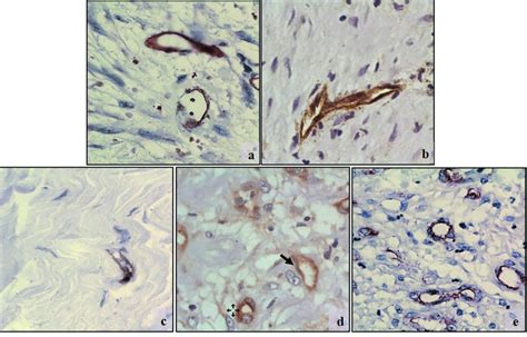 Cd105 Immunostaining In Endothelial Cells A Nodular Fasciitis Download Scientific Diagram