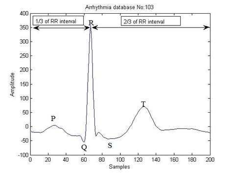Ecg Beat Segmentation Iii Differential Evolution The Genetic Algorithm