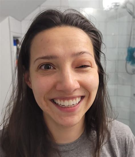 Spider Bite Swollen Eye