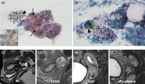 Representative Findings Of Cervical Pap Smear A And B And Mri C F