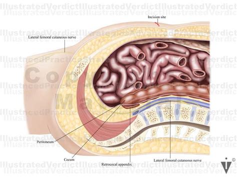 Stock Appendix Appendicitis Retrocecal — Illustrated Verdict