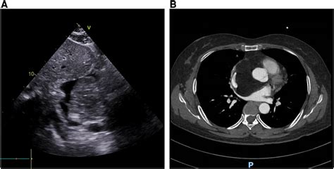 The Imaging Feature Of The Cardiac Mass A Echocardiography Revealed