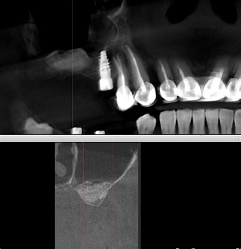 Синус лифтинг