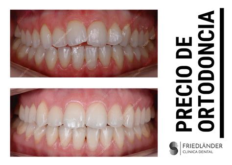 Precio De Ortodoncia ¿por Qué Cuesta Lo Que Cuesta