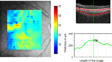 Figure 1 From Oct Segmentation Using Convolutional Neural Network Semantic Scholar