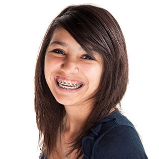 Orthodontic Retention Gsd Orthodontics Tampa Fl