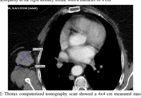 Figure 2 From Biphasic Synovial Sarcoma A Rare Cause Of Axillary Mass