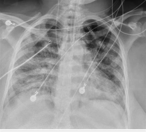 Chest Radiography Cxr On Hospital Day Five Showed Diffuse Download Scientific Diagram