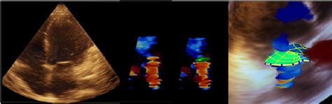 Example Of A Tte Volume Data And The Fitted Mitral Valve Model A