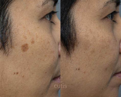 Best Pico Laser Packages Brisbane Cutis Dermatology