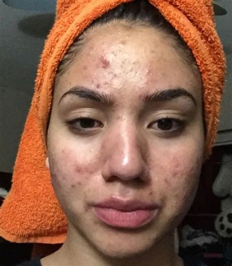 Acne Detection Object Detection Dataset By Skin Care